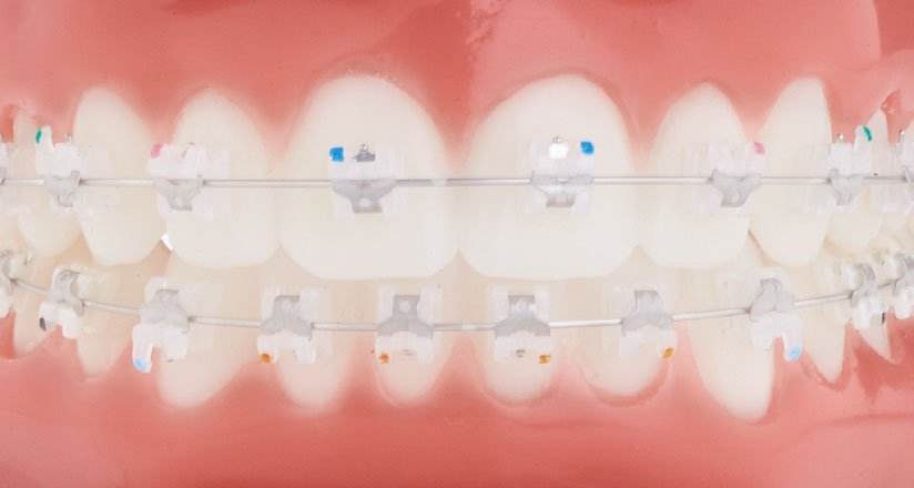 Keramik Brackets | Kieferorthopäde Velbert